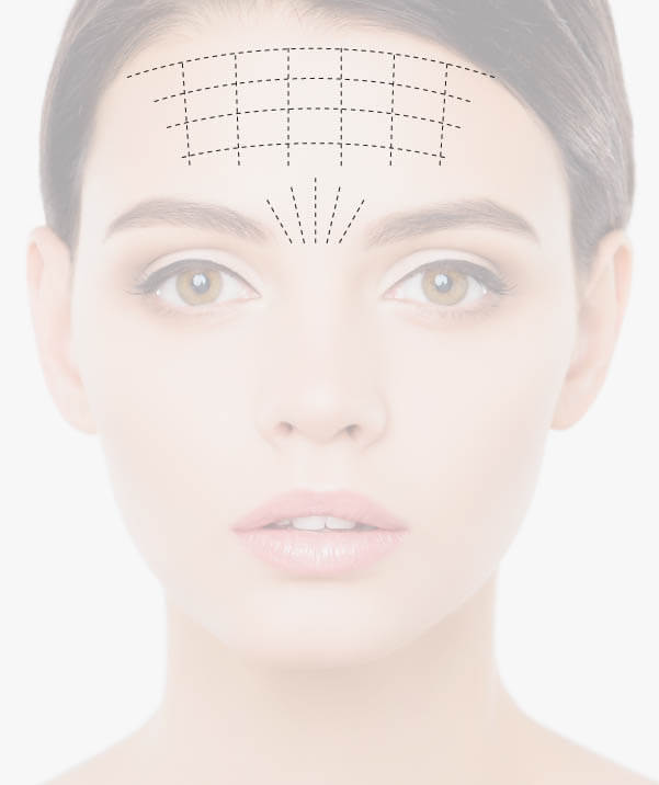 Fils Tenseurs Collagène pour Soins Esthétiques - Epotam Esthetic